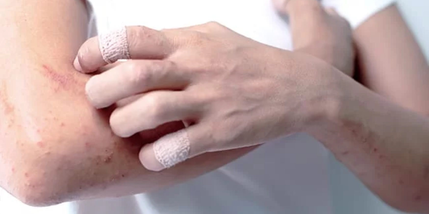 How to Get Rid of Eczema - Adventure Crunch