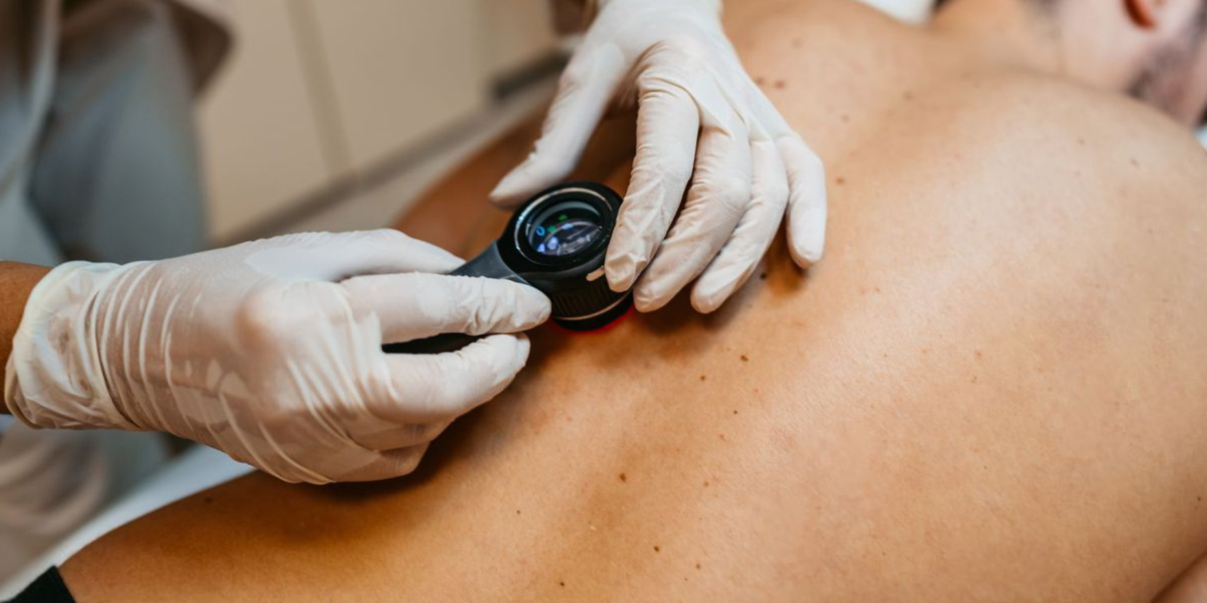 Understanding Melanoma: Causes, Symptoms, and Treatments - Adventure Crunch Understanding Melanoma: Causes, Symptoms, and Treatments - Adventure Crunch